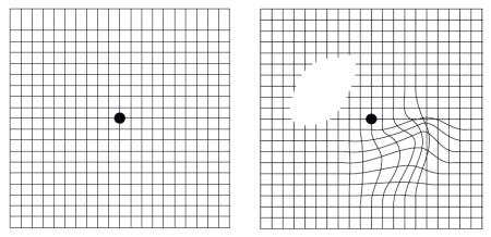 DMLA (Dégénérescence maculaire liée à l'âge) - Cabinets OPH59